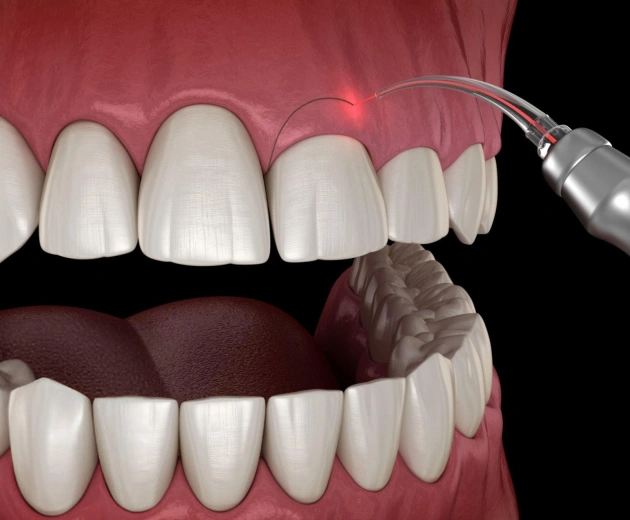 Frenectomy Falls Church VA | LP Dental